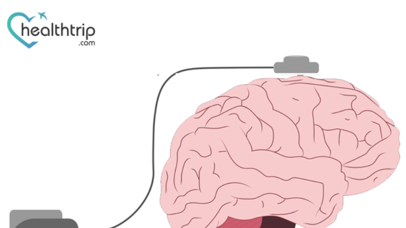 Life After Deep Brain Stimulation (DBS) Surgery | HealthTrip | HealthTrip
