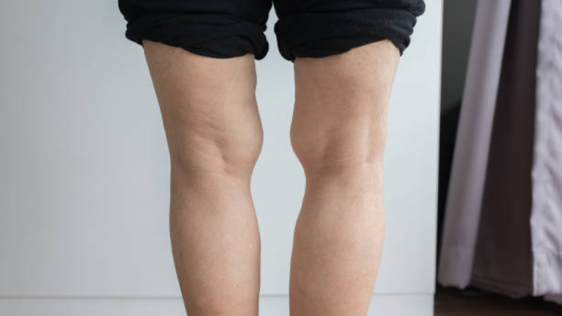 A Comprehensive Guide to Knock Knee Surgery